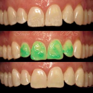 ICON Resin Infiltration Prior Lake MN, Prior Lake Dental